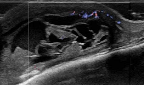 Musculoskeletal Joints And Tendons 62 Elbow Case 625 Olecranon