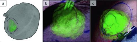 Case 3 A 3d Rendered Mri And Segmented Tumour Virtual Patient Model