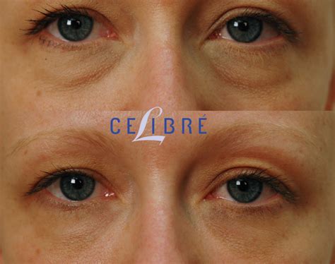 Juvederm Before And After Pictures Real Patient Results
