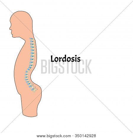 Lordosis Images Illustrations And Vectors Free Bigstock