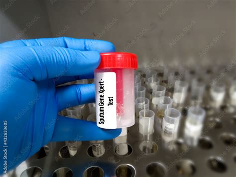 Fotka „sputum Sample Container Holding By Doctor For Genexpert Test A Molecular Test For