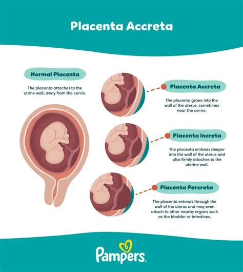 Placenta Acreta Vs Placenta Normal Placenta Previa Information Mount
