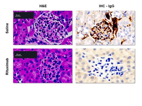 Systemic Lupus Erythematosus Sle — Invivocue Leading Expert In