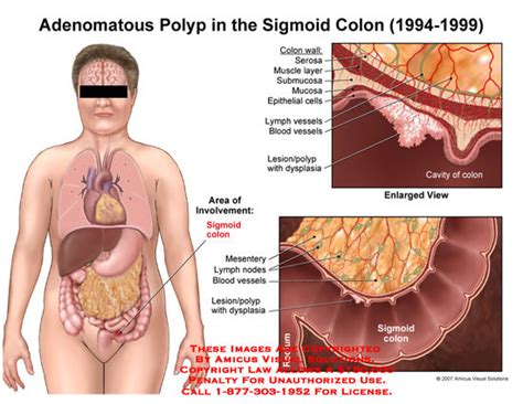 Amicus Illustration Of Amicus Medical Polyp Adenomatous Sigmoid Colon