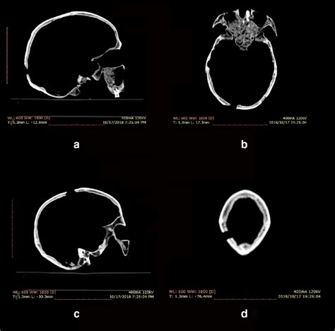 Selected Sagittal Ct Scan Sessions Of This Individual A B