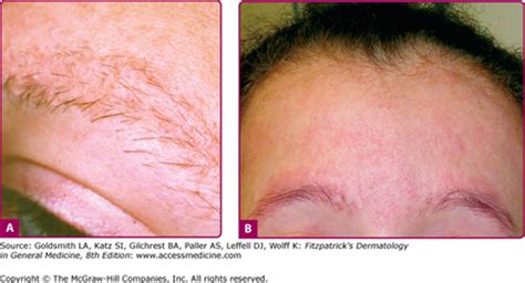Keratosis Pilaris Atrophicans Faciei