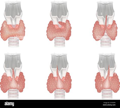 Pyramidal Lobe Variations In Thyroid Anatomy And Pyramidal Lobe