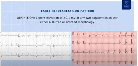 Early Repolarization