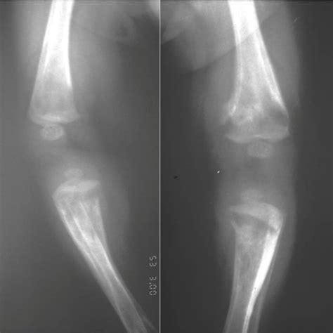 Clinical Appearance Of A 7 Day Old Girl With Pseudoparalysis Of The