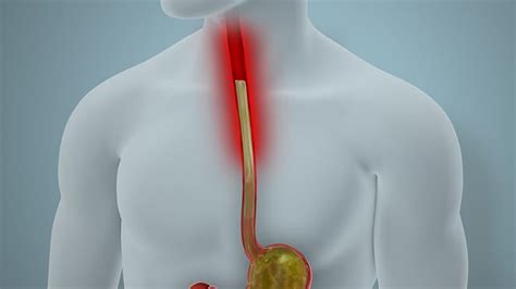 New Endoscopic Method For Gerd Diagnosis Shows High Accuracy