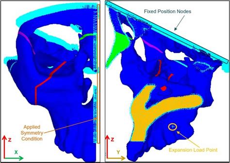 Partial Skull Geometry Generated From Pre Me Treatment Cbct Scans