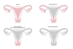 Hysterektomie Erklärt Wirkung Durchführung And Anwendung Ursprung