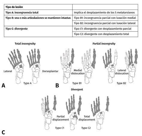 Lesiones De La Articulación De Lisfranc Experiencia En El Tratamiento