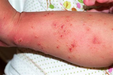 Scabies Au