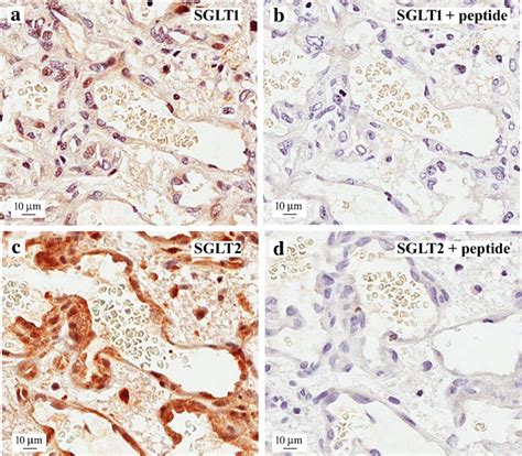 Expression Of Sglt2 In A Microvascular Proliferation In A Glioblastoma Download Scientific