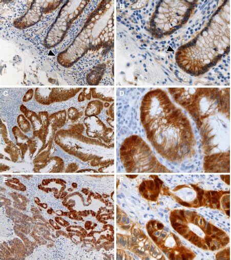 β Catenin Immunohistochemical Staining Of Formalin Fixed Download Scientific Diagram
