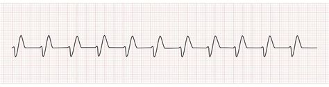 Ekg Monitor Showing Wide Qrs Complex From Hyperkalemia 45881038 Vector