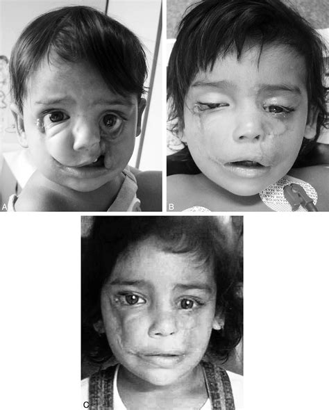 Is Amniotic Band Dangerous At Lachlan Legge Blog