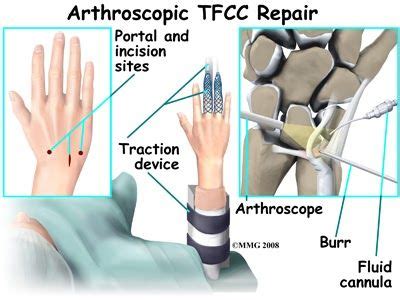 50 Tfcc Ligament Wrist Images Tfcc Tear Exercises Scaphoid Fracture