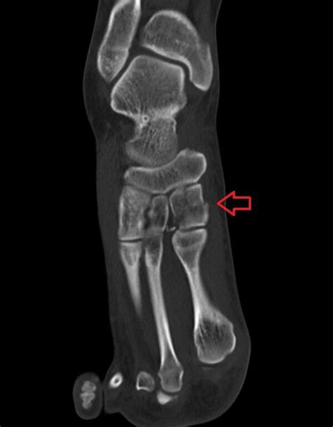 Cuneiform Fracture Wikism Sports Medicine Wiki