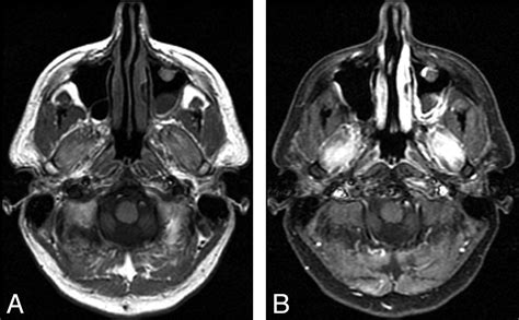 Lateral Pterygoid Muscle Rhabdomyolysis American Journal Of Neuroradiology