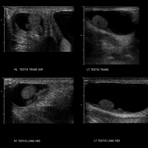 Pediatric Hydrocele Pediatric Radiology Reference Article Pediatric Imaging Pedsimaging