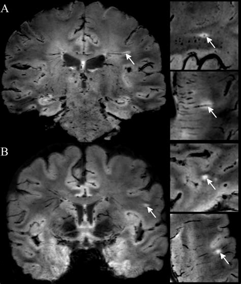 Examples Of 3t Flair Imaging Demonstrating The Central Vessel Sign