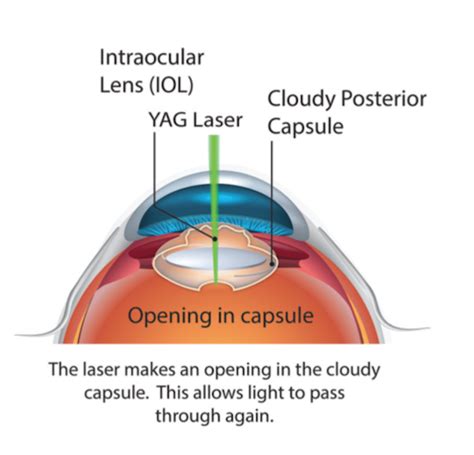 Posterior Capsular Opacification Relief In Central Illinois Chittick Eye Care