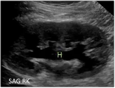 Eds Urinary System Pathology 1 Hydronephrosis Lithiasis