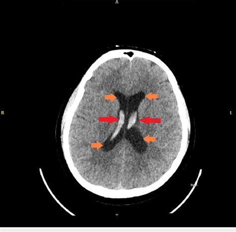 Before External Ventricular Drain Evd Placement There Is Increased