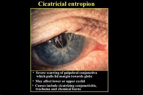 Ectropion And Entropion
