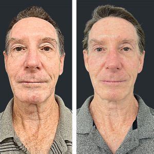 Hifu Treatment 10 50 Off Face Neck Tummy Arms Knees Thighs