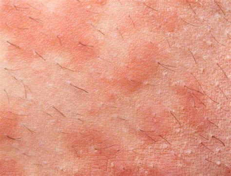 Bumps On Scrotum That Itch New Health Advisor