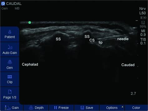 Ultrasound Guided Caudal Block Anesthesia Key
