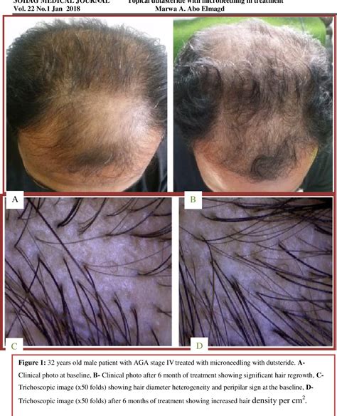 Dutasteride Guide Uses Results And Side Effects Wimpole