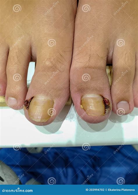 Close Up Of Toes Ingrown Toenail Problem Beginning Of Healing Of An Inflamed Big Toe With An