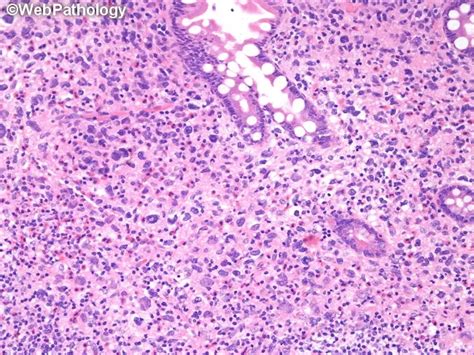 Histiocytic Sarcoma
