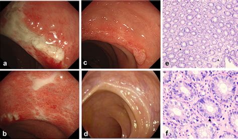 Full Article Association Between Sars Cov 2 Infection And Acute