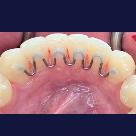 Correcting Posterior Crossbite Using Rubber Bands Artofit