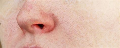Nasal Vestibulitis Causes Symptoms Treatment And Prevention