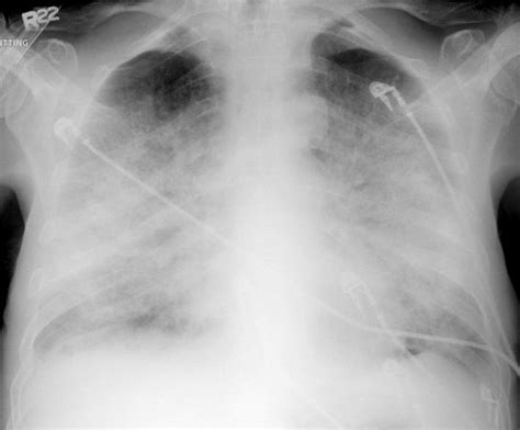 Pulmonary Edema Chest X Ray