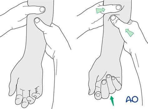 Closed Reduction Splinting For Extraarticular Fracture Of The Proximal End Segment