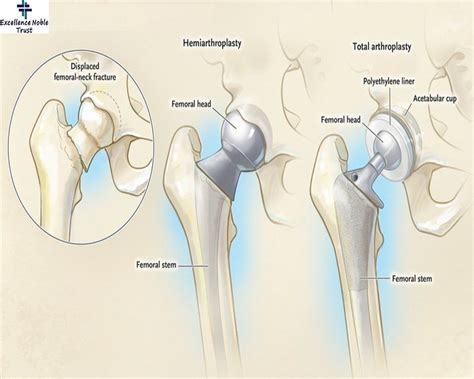 Best Joint Replacement Surgery Specialist In India
