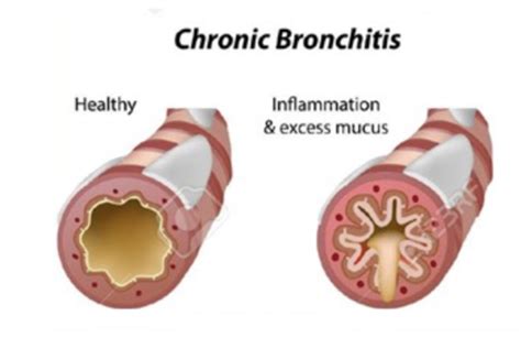 Overview Of Obstructive And Restrictive Pulmonary Diseases Flashcards Quizlet