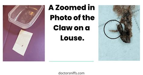 Lice Vs Bed Bugs Ultimate Guide With Photos