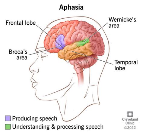 Neuroprosthetics To Decode Speech Disorders StMU Research Scholars