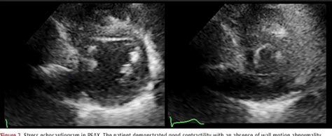 Figure 2 From Sinus Node Dysfunction Triggered By Tonsillar Abscess