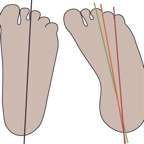 Apophysitis Locations 1 Iliac Crest 2 Anterior Superior Iliac