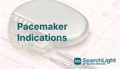 Pacemaker Indications Cardiac Pacemaker Md Searchlight