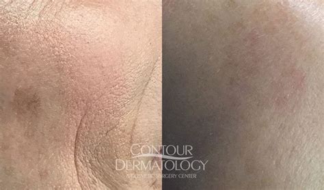Picoway Resolve Laser Before And After Photo Gallery